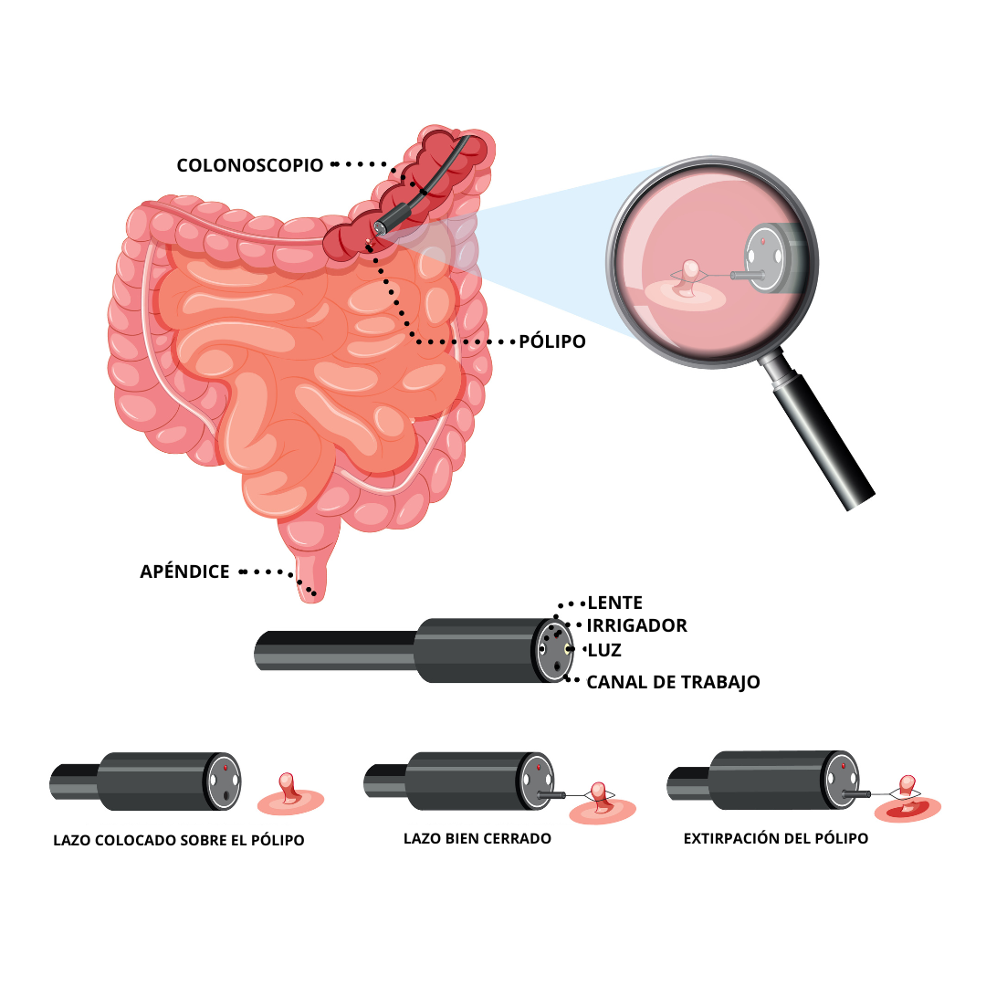 Colonoscopia Queretaro - Dr. Claudio Marmolejo